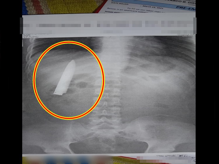 Guy Discovers Knife Stuck Inside His Body for 14 Months Through X-ray