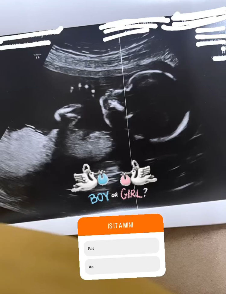 Aeriel Garcia Shares Sonogram Of First Child With Patrick Sugui