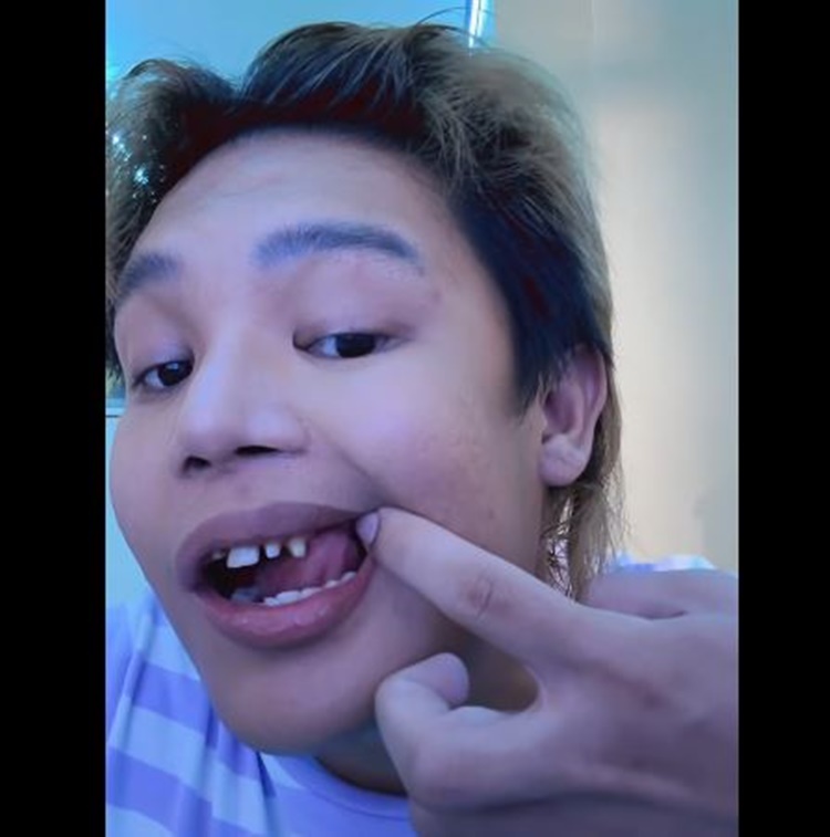 Xander Ford Seeks Help for Dental Treatment “Sobrang mahal” | Newspapers