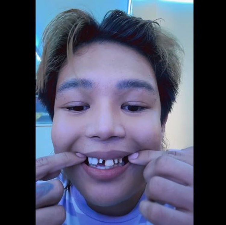 Xander Ford Seeks Help for Dental Treatment “Sobrang mahal” | Newspapers